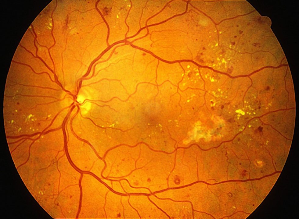 Diabetic Eye Disease Plano, TX | Texas Macula and Retina