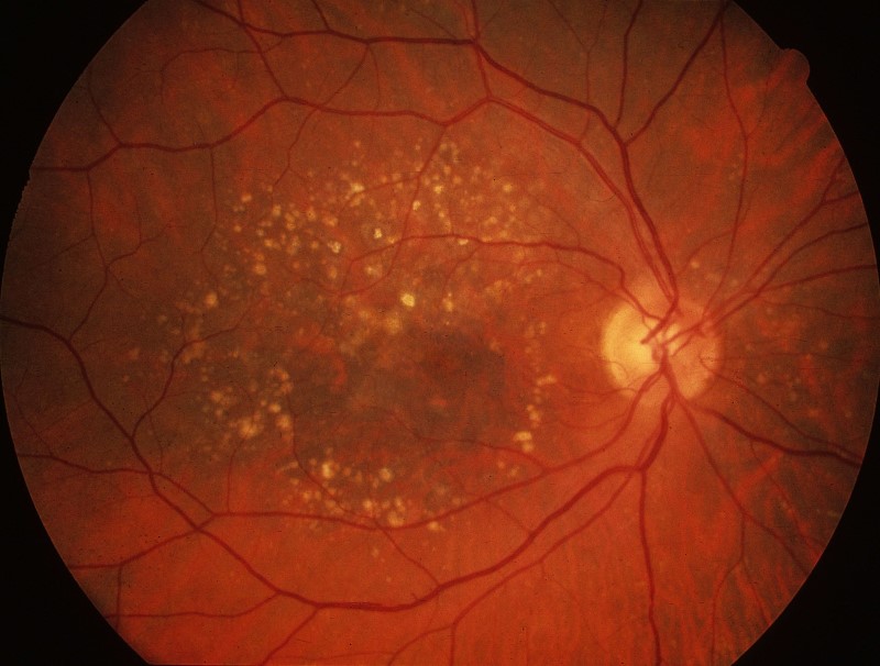 Macular Degeneration Plano, TX | Texas Macula and Retina