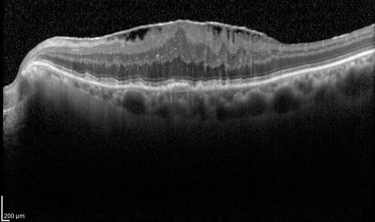 Epiretinal Membrane and Macular Pucker Plano, TX | Texas Macula and Retina