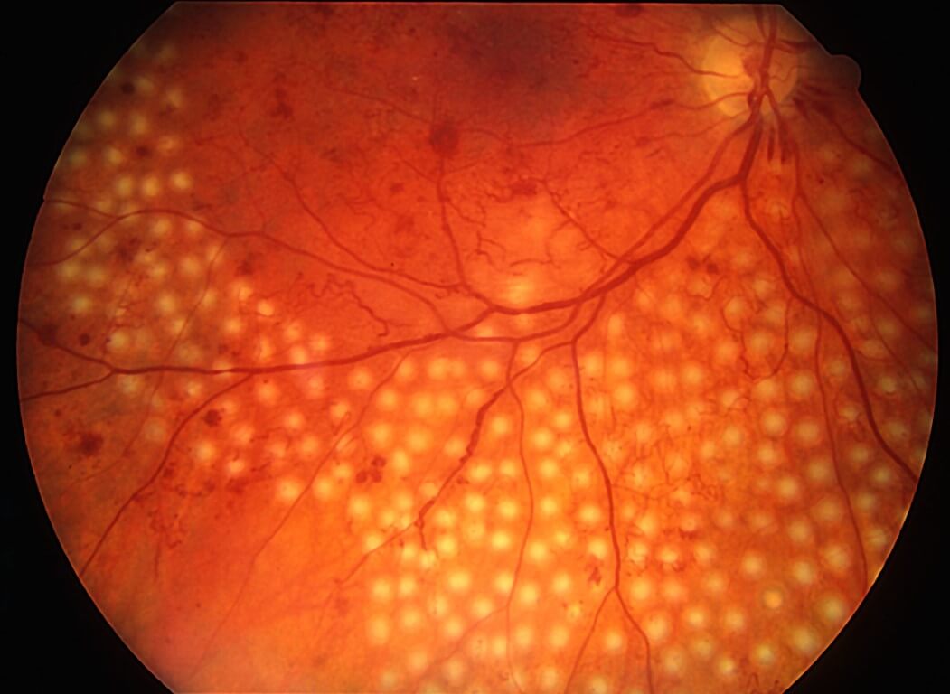 Diabetic Eye Disease Plano, TX | Texas Macula and Retina