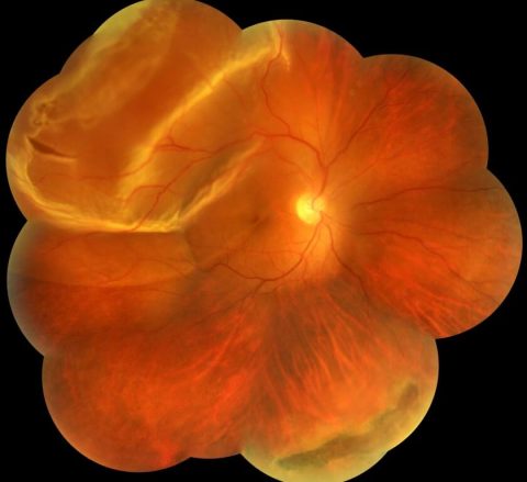 Retinal Tears and Detachments Plano, TX | Texas Macula and Retina