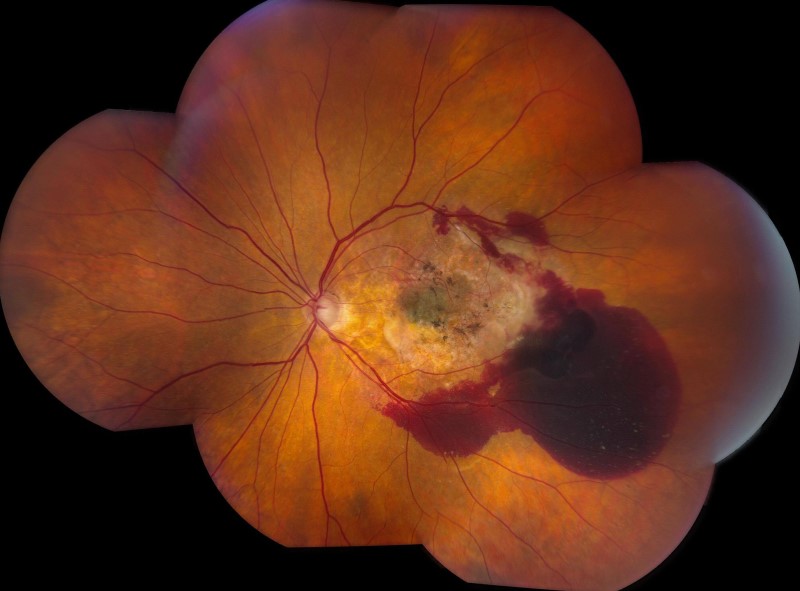 Macular Degeneration Plano, TX | Texas Macula and Retina