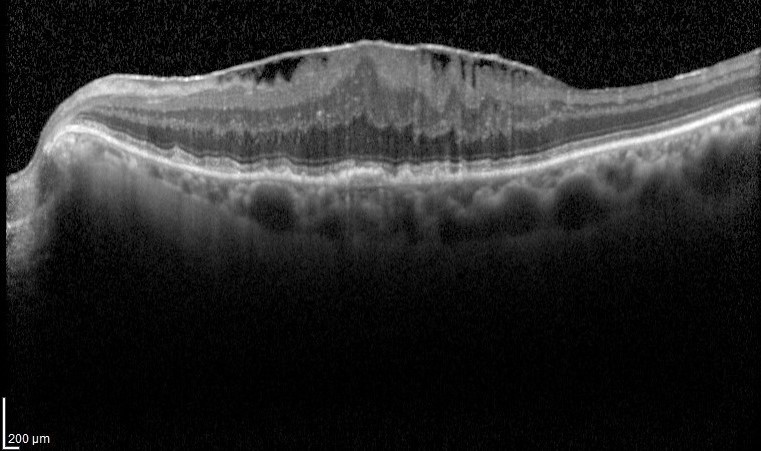 Epiretinal Membrane and Macular Pucker Plano, TX | Texas Macula and Retina